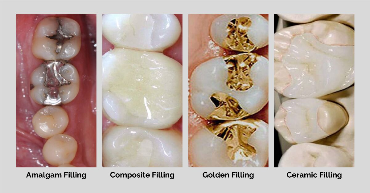 DENTAL FILLING OR TEETH FILLINGS - Bateman Dental